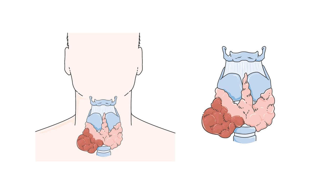 Predicting Thyroid Cancer Recurrence with Machine Learning | Science ...